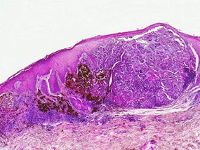 Pictures of Nodular Melanoma