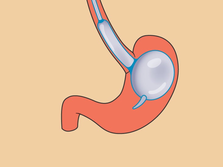 Sengstaken-Blakemore Tube: Purpose, Procedure, and Complications