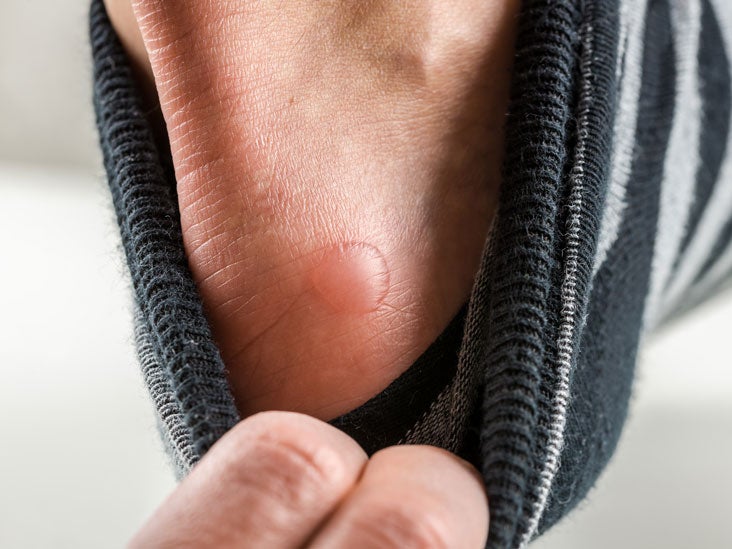 Vesicles: Causes, Symptoms, and Diagnosis