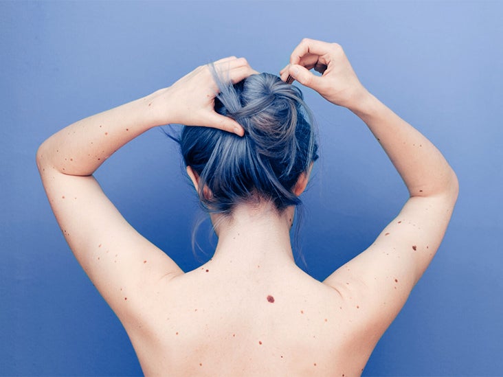 No Sun? You Should Still Get Those Moles Checked
