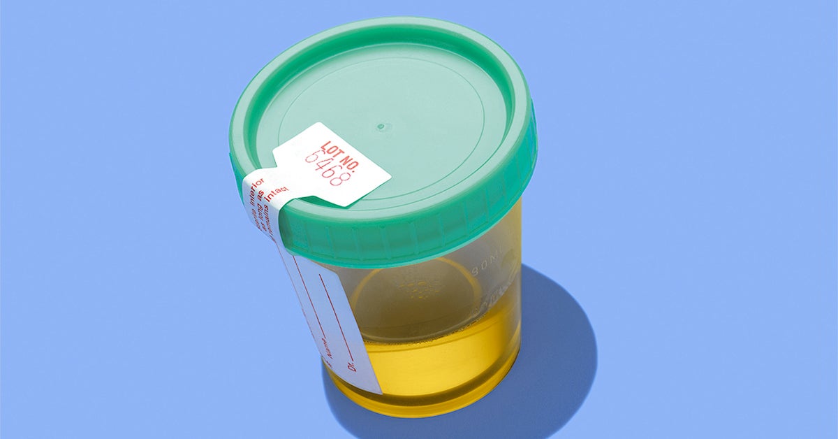 Glucose Urine Test Purpose Procedure Results