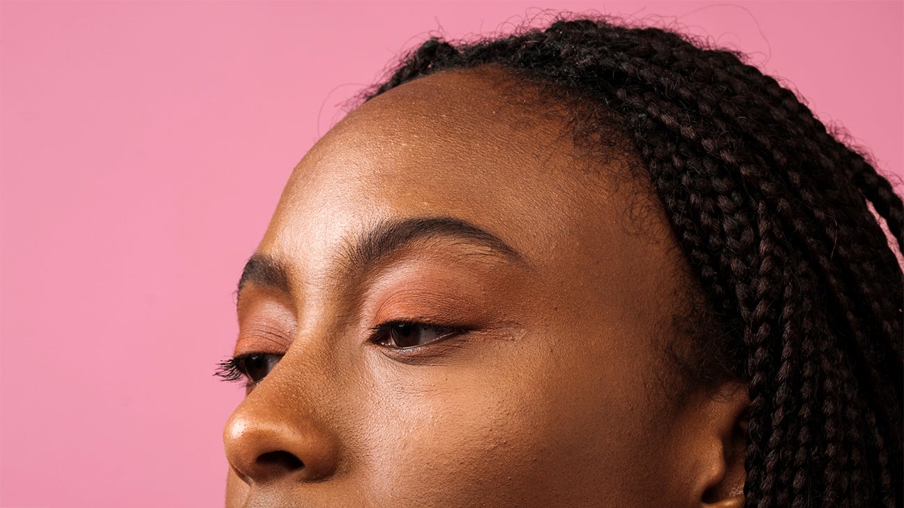 Pimples on Hairline: Causes, Treatment, and Prevention