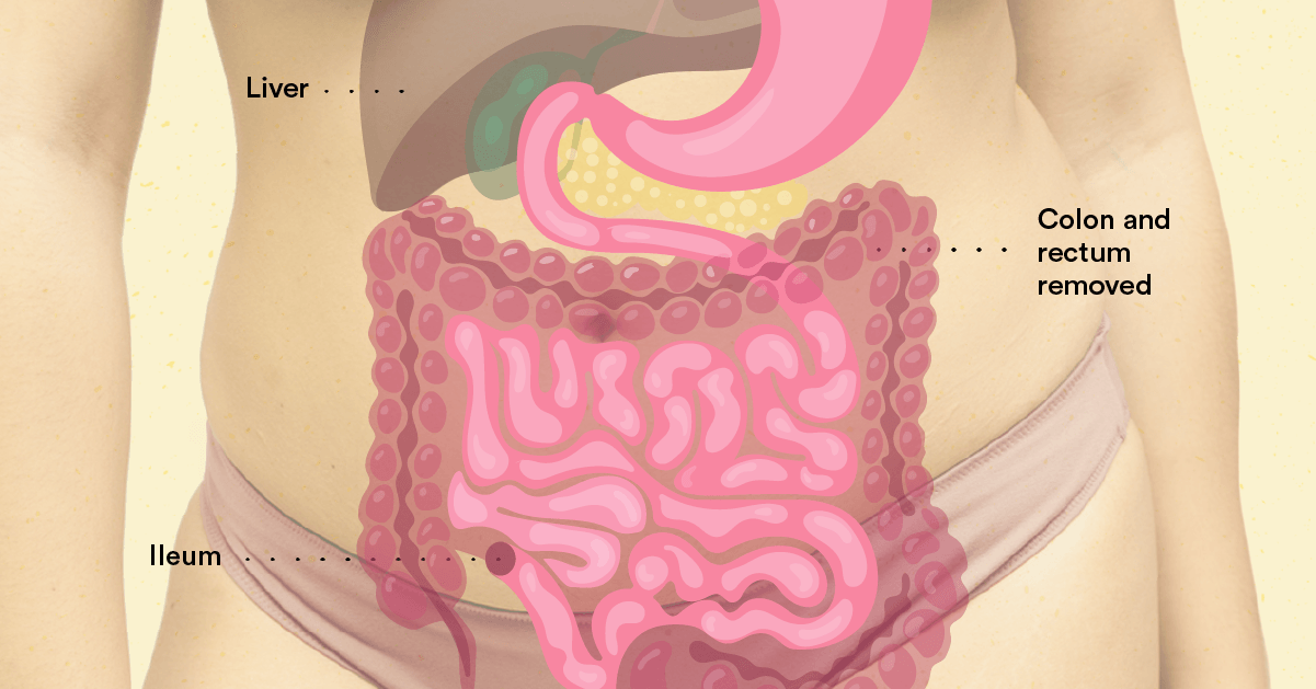What Is J Pouch Surgery Procedure Stages What Is J Pouch Surgery Procedure Stages