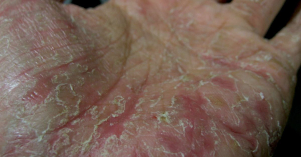 Dyshidrotic Eczema Symptoms Causes And Treatment dyshidrotic-eczema-symptoms-causes-and-treatment