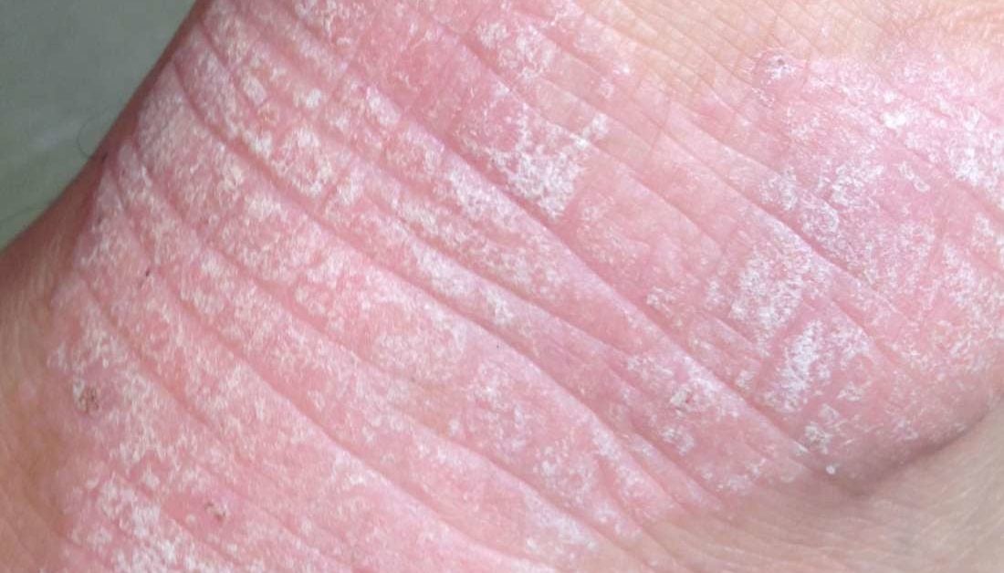 Dermatitis herpetiformis: Causes, treatment, and pictures