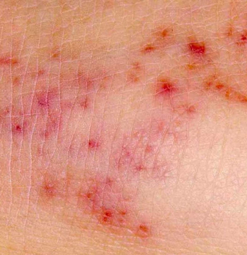 Pictures Of Skin Rashes Pictures Of Skin Rashes