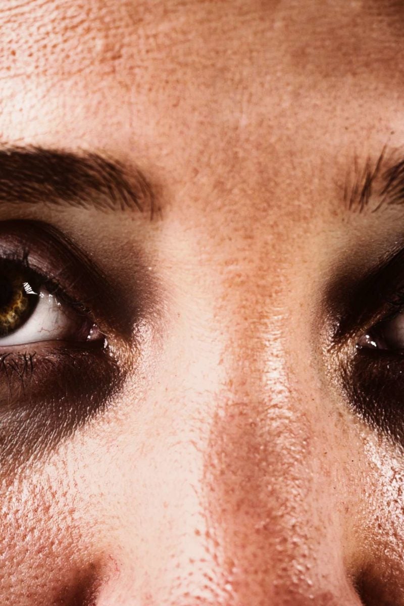 Dark Circles Under The Eyes Causes And Treatments Dark Circles Under The Eyes Causes And Treatments